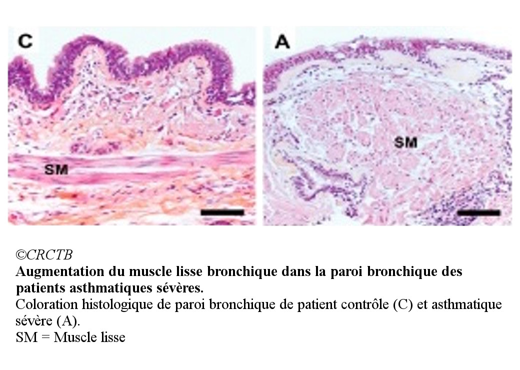 Remodelage bronchique - Centre de recherche cardio-thoracique de Bordeaux